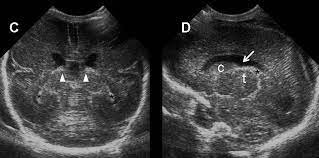 Ecografia Transfontanellare :: RxMedicalCenter