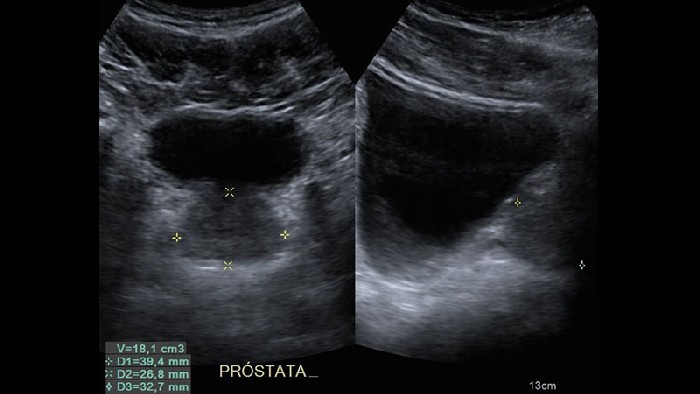 Ecografia Prostatica :: RxMedicalCenter